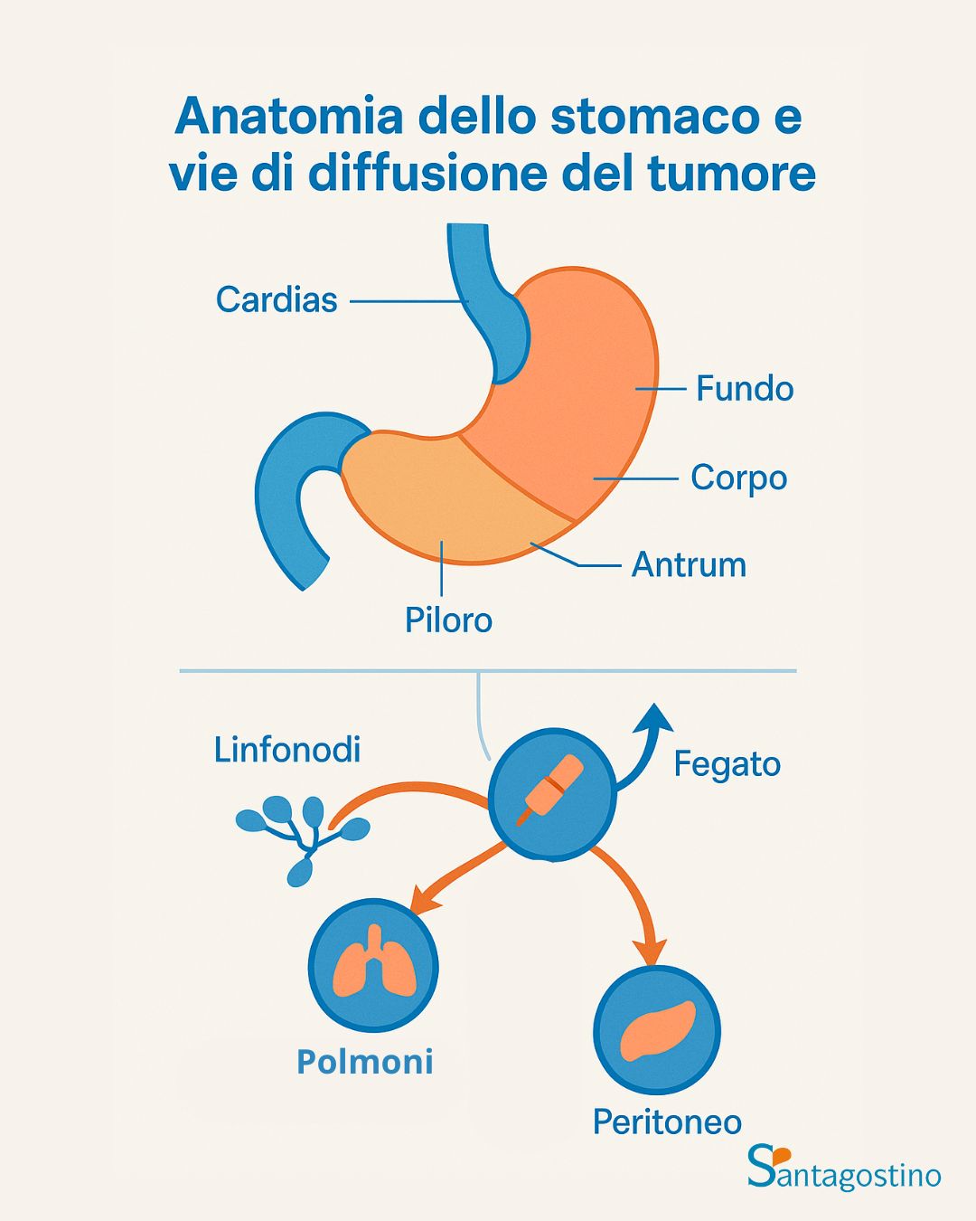 Il tumore allo stomaco: sintomi e prevenzione - Santagostino Nembro